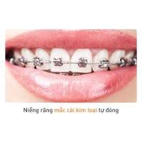 DỊCH VỤ NIỀNG RĂNG MẮC CÀI KIM LOẠI TỰ BUỘC TRẢ GÓP TPHCM - Nha khoa uy ...
