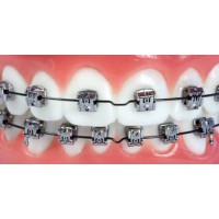 Dịch vụ niềng răng mắc cài tự buộc tại Gò Vấp - Nha khoa uy tín quận Gò ...